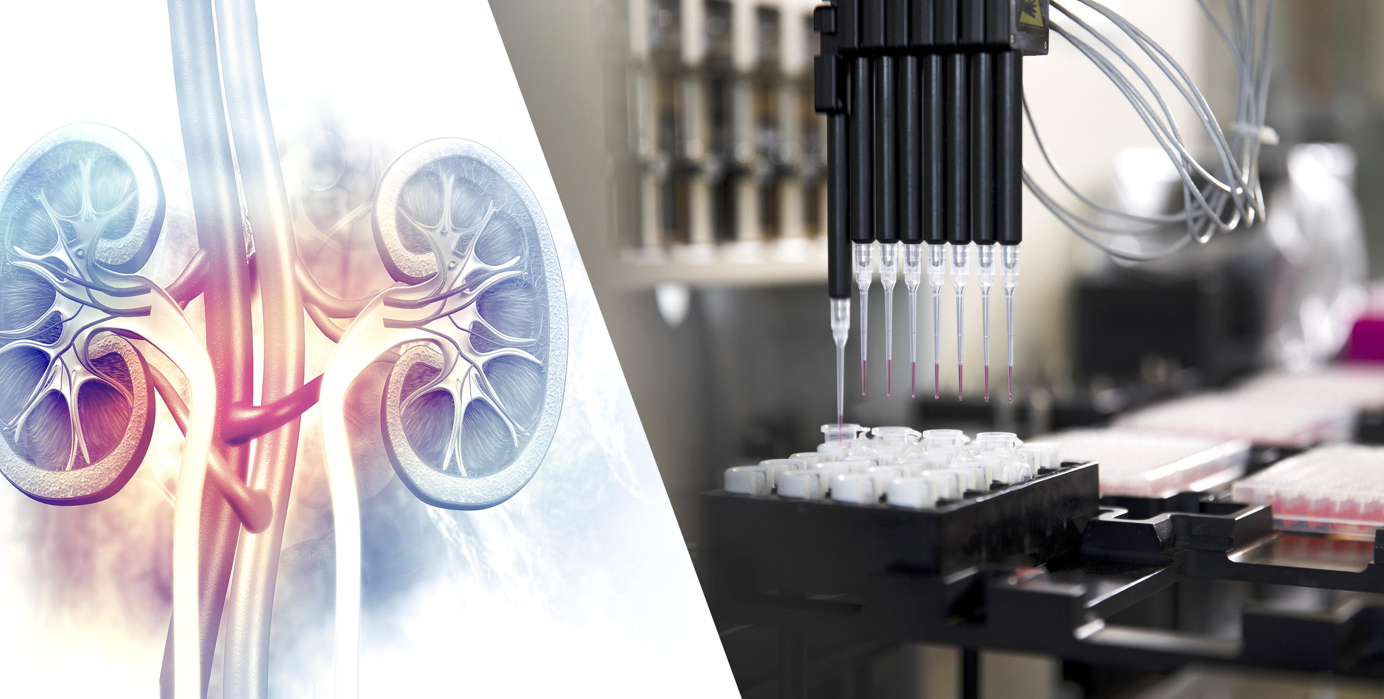 Transforming kidney transplantation with pioneering epitope-based ...