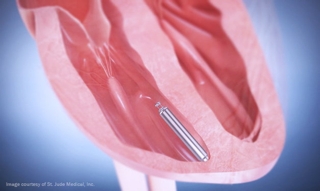 Canada’s smallest pacemaker implanted in VGH patient’s heart | VCH ...