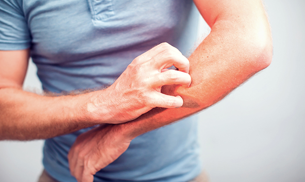 Saving skin—research identifies an enzyme that may cause blistering ... Saving skin—research identifies an enzyme that may cause blistering ...