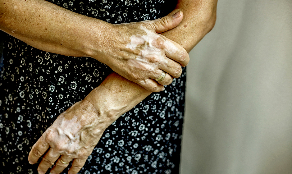 Ask an expert: What causes white skin patches? | VCH Research Institute